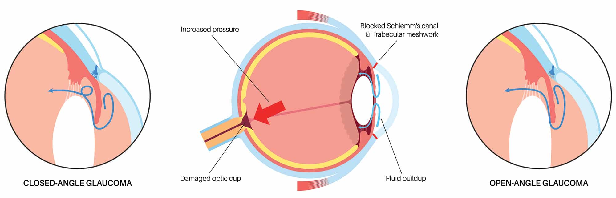 Glaucoma Treatment Charleston | Glaucoma Evaluation Ripley, WV