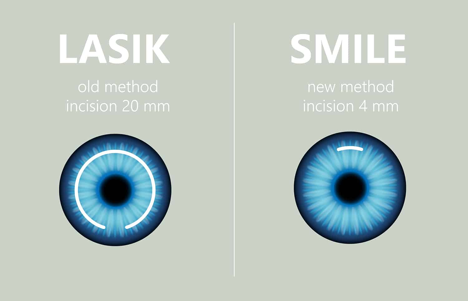 SMILE Eye Surgery Charleston | Laser Vision Correction Beckley